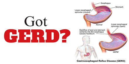 Do You Have Acid Reflux - Or GERD?